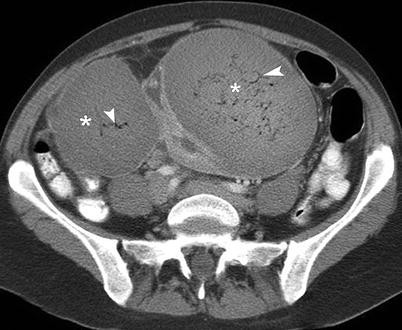 Spectrum of imaging findings on MRI and CT after uterine artery ...