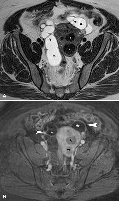 Spectrum of imaging findings on MRI and CT after uterine artery ...