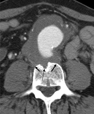 Sealed rupture of abdominal aortic aneurysms: CT features in 6 patients ...