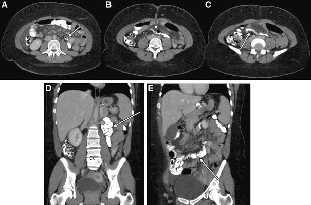 Petersen’s hernia as a complication of bariatric surgery: CT findings ...