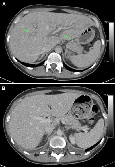 Clinical significance of periportal tracking as an extrarenal ...