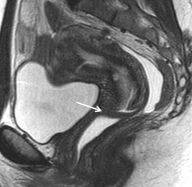 Mullerian duct anomalies: MR imaging | SpringerLink
