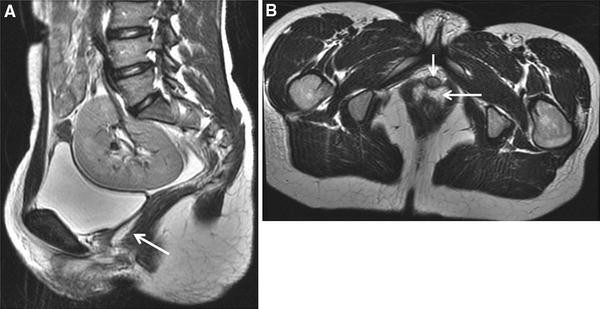 Mullerian duct anomalies: MR imaging | SpringerLink