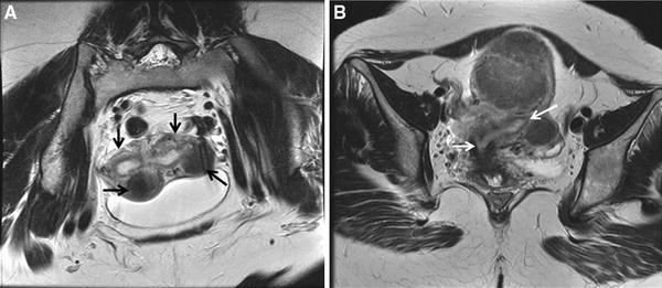 Mullerian duct anomalies: MR imaging | SpringerLink