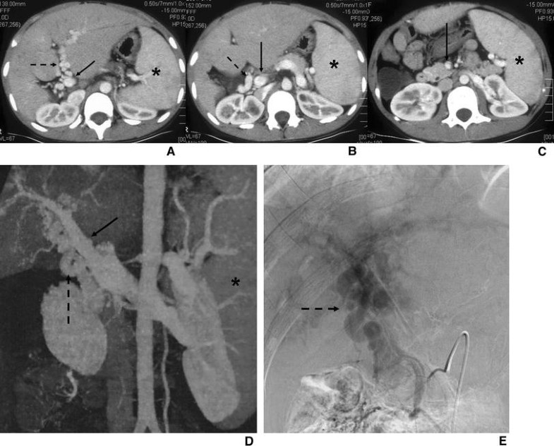 Cavernous vessels around a patent portal trunk in the liver hilum ...