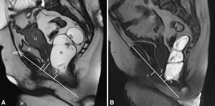 Dynamic pelvic floor imaging: MRI techniques and imaging parameters ...