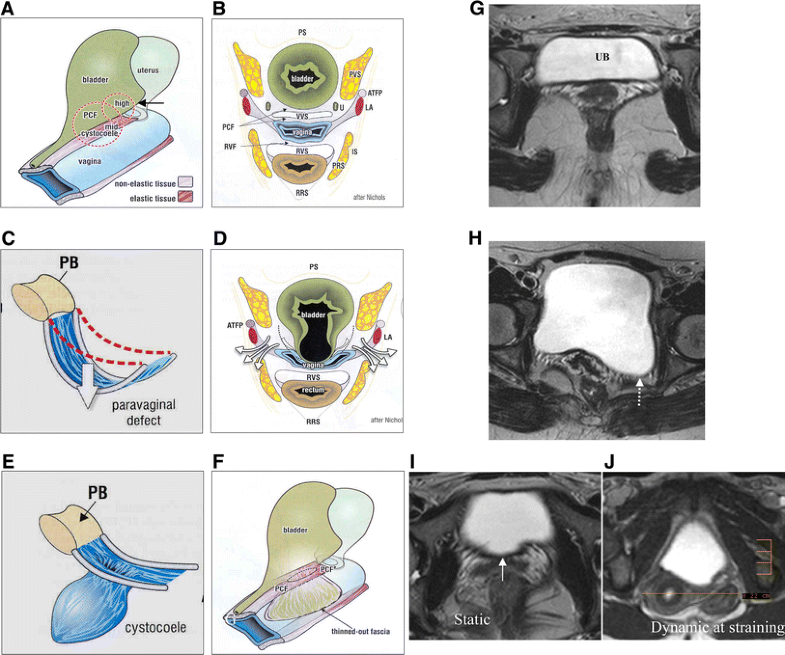 The urogynecological side of pelvic floor MRI: the clinician’s needs ...