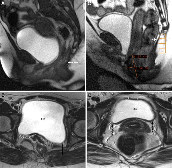 The urogynecological side of pelvic floor MRI: the clinician’s needs ...