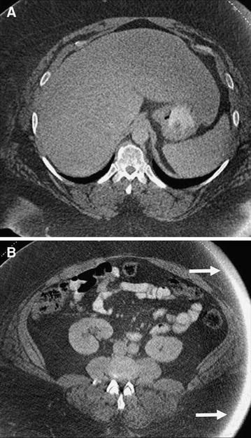 Imaging obese patients: problems and solutions | SpringerLink