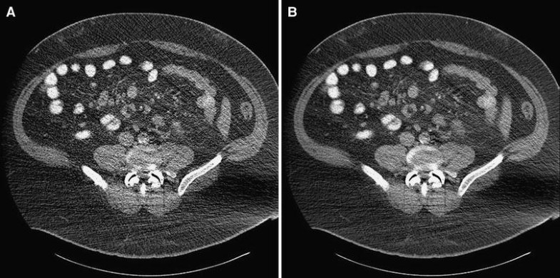 Imaging obese patients: problems and solutions | SpringerLink