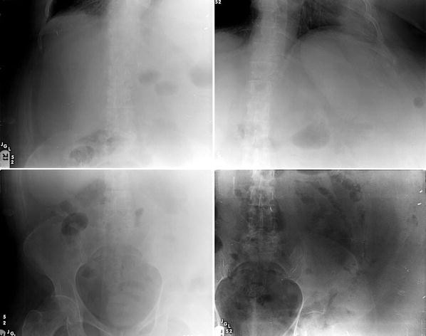 Imaging obese patients: problems and solutions | SpringerLink