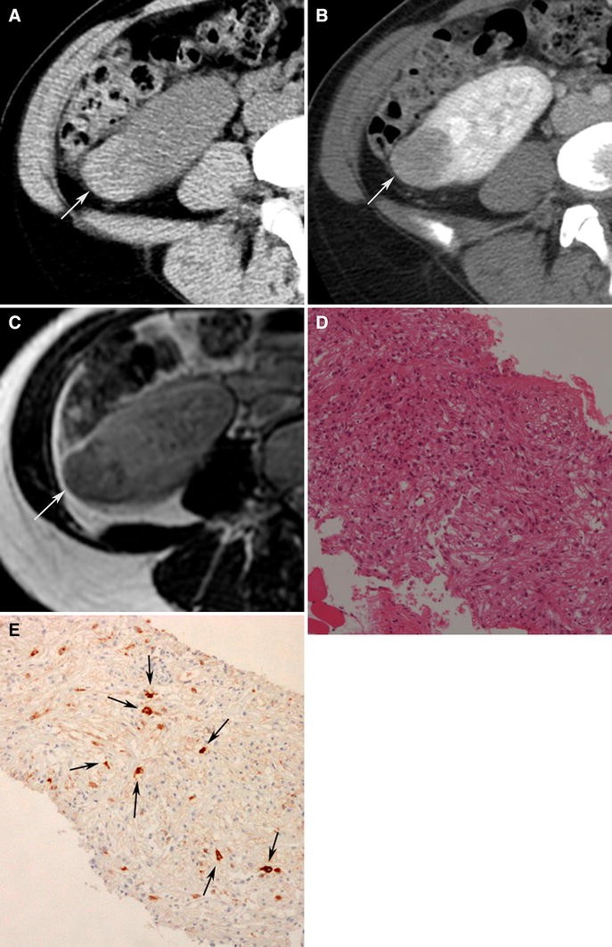 Renal angiomyolipoma: a radiological classification and update on ...