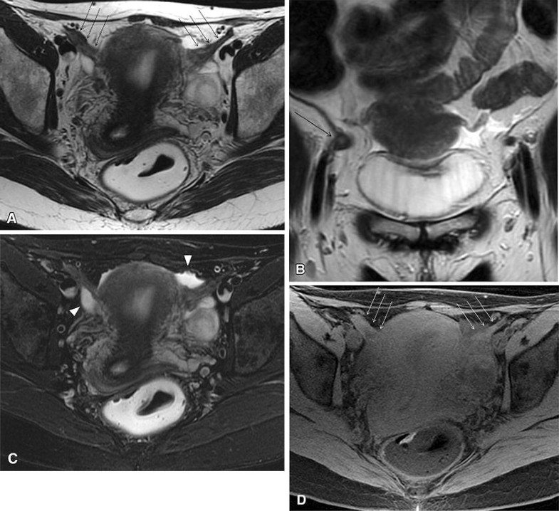 Deep pelvic endometriosis: don’t forget round ligaments. Review of ...