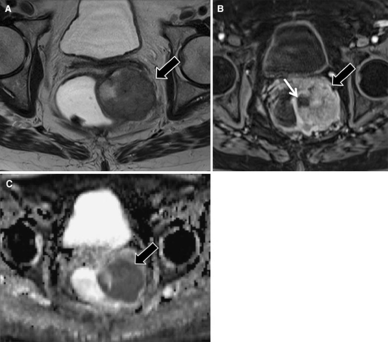 Benign and malignant tumors of the rectum and perirectal region ...