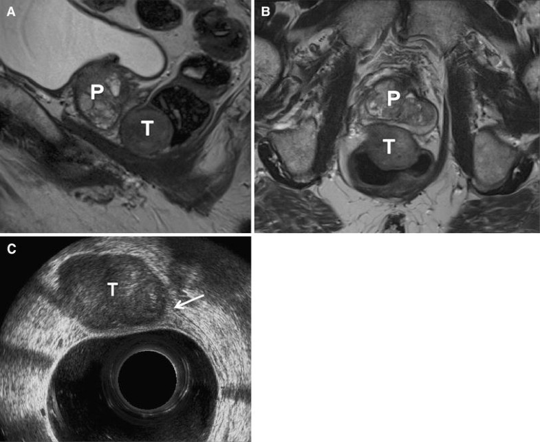 Benign and malignant tumors of the rectum and perirectal region ...