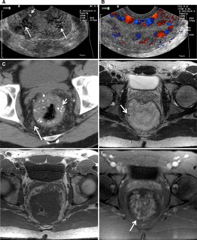 Benign and malignant tumors of the rectum and perirectal region ...