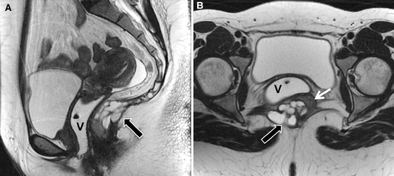 Benign and malignant tumors of the rectum and perirectal region ...
