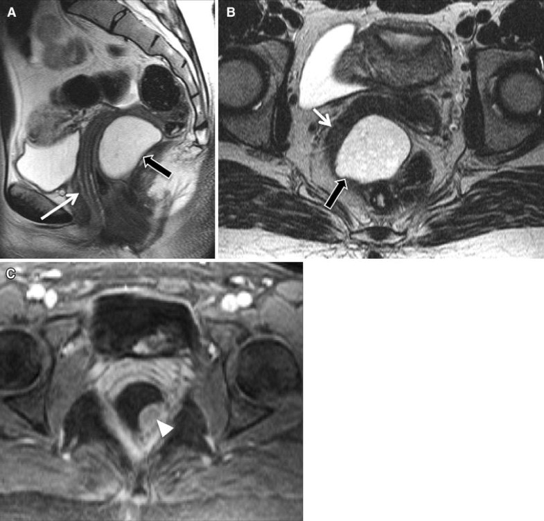 Benign and malignant tumors of the rectum and perirectal region ...