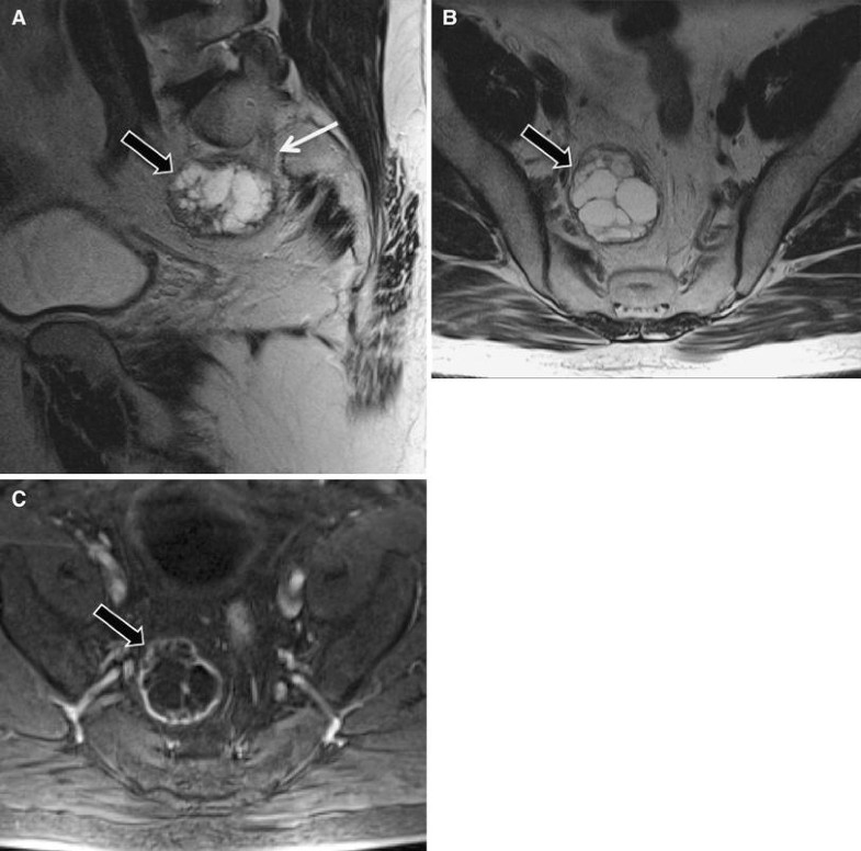 Benign and malignant tumors of the rectum and perirectal region ...