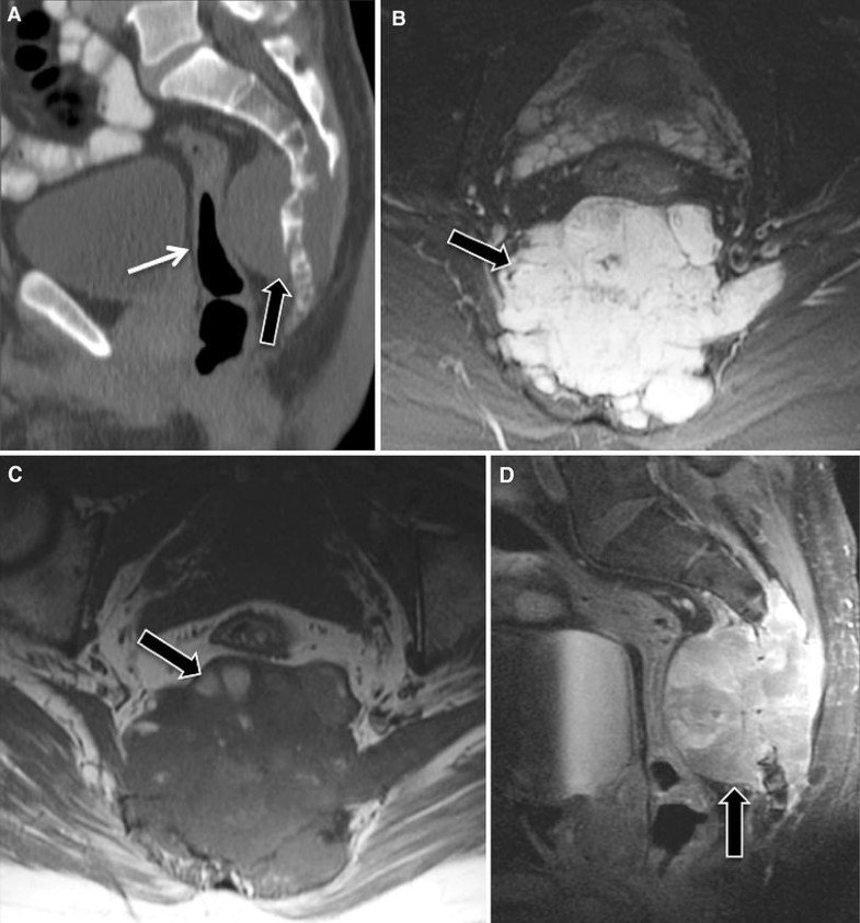 Benign and malignant tumors of the rectum and perirectal region ...