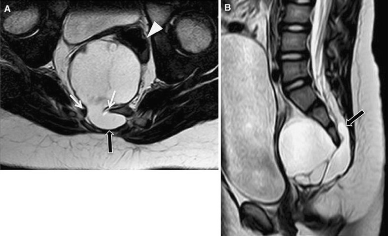 Benign and malignant tumors of the rectum and perirectal region ...