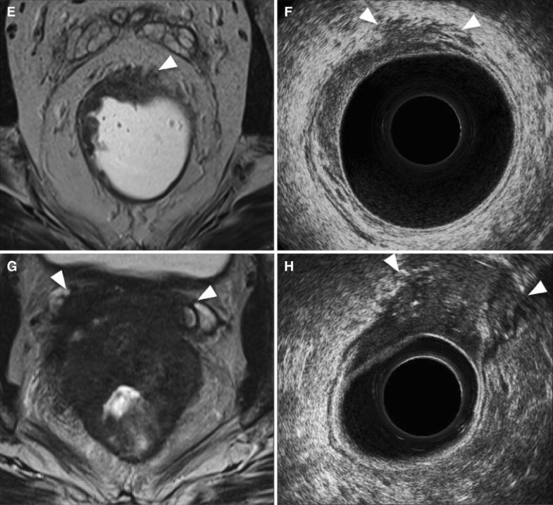 Benign and malignant tumors of the rectum and perirectal region ...