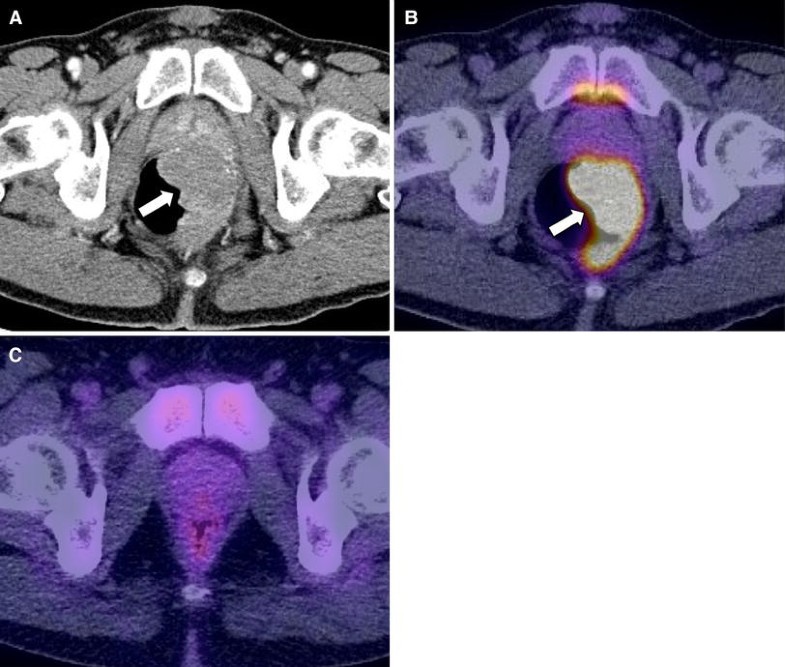 Benign and malignant tumors of the rectum and perirectal region ...