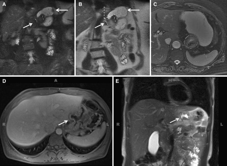 MRI of the stomach: a pictorial review with a focus on oncological ...