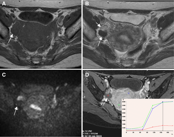 Magnetic resonance imaging features of ovarian fibroma, fibrothecoma ...