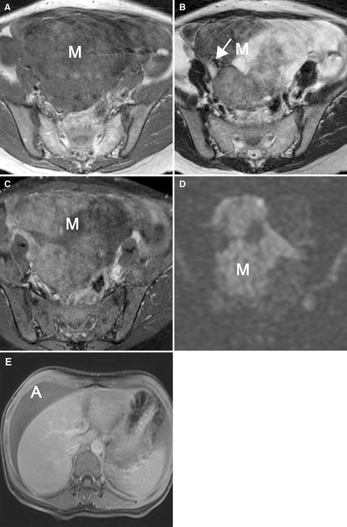 Magnetic resonance imaging features of ovarian fibroma, fibrothecoma ...