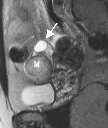Magnetic resonance imaging features of ovarian fibroma, fibrothecoma ...