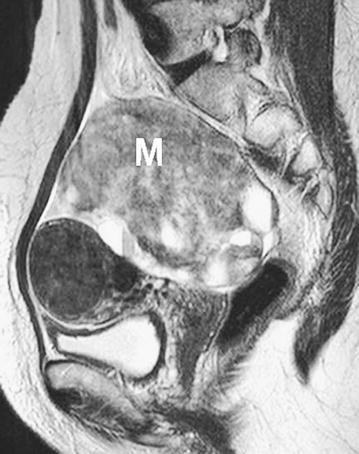 Magnetic resonance imaging features of ovarian fibroma, fibrothecoma ...