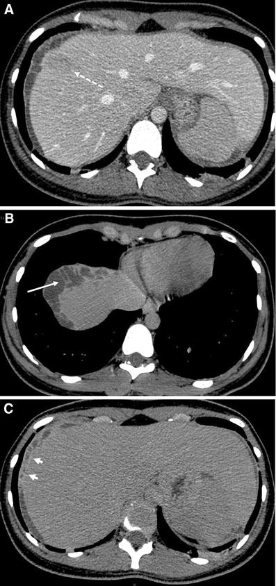 Hepatic and perihepatic involvement of female genital diseases and ...