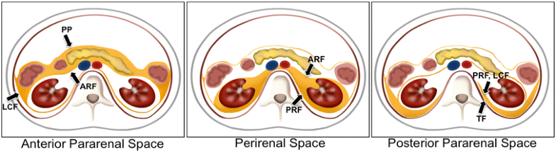 Primary retroperitoneal masses: what is the differential diagnosis ...