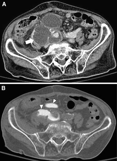 Primary retroperitoneal masses: what is the differential diagnosis ...