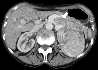 Primary retroperitoneal masses: what is the differential diagnosis ...
