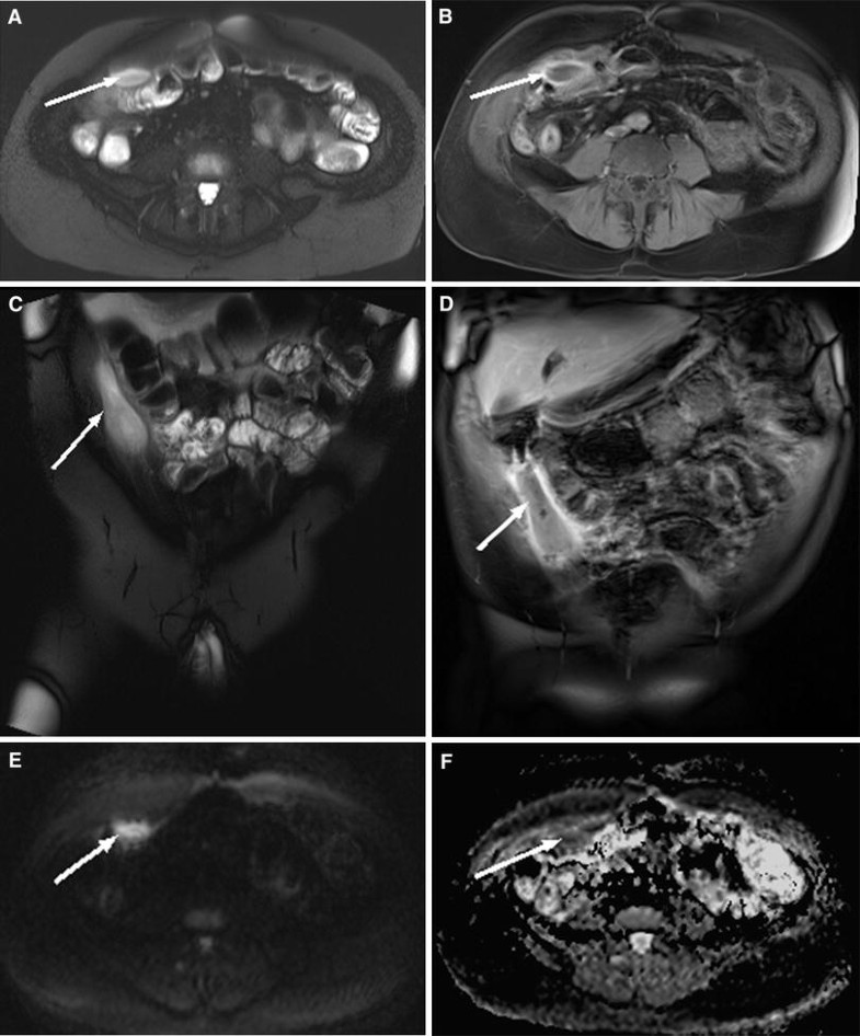 MR enterography in Crohn’s disease: current consensus on optimal ...