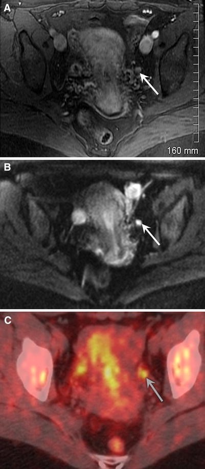 PET/CT and MRI in the imaging assessment of cervical cancer | SpringerLink