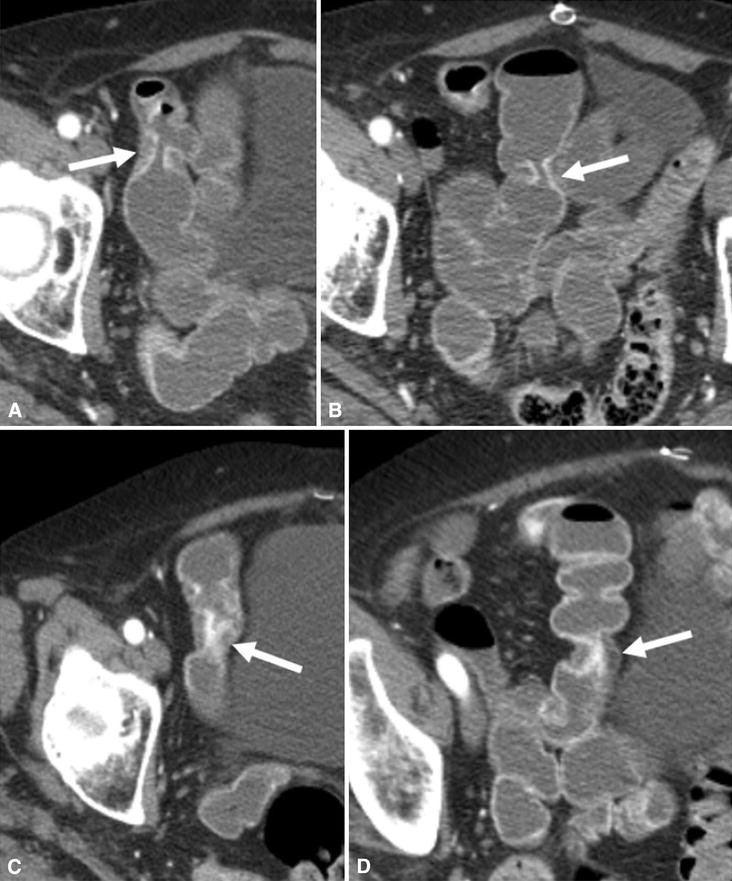 NSAID enteropathy: appearance at CT and MR enterography in the age of ...