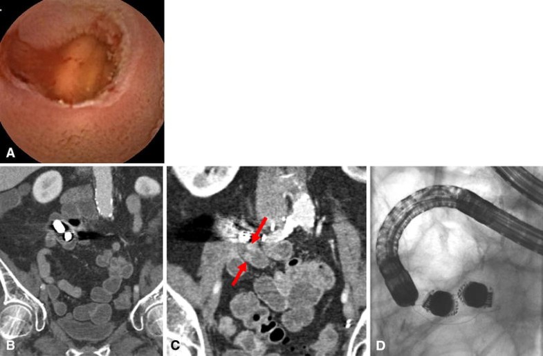 NSAID enteropathy: appearance at CT and MR enterography in the age of ...