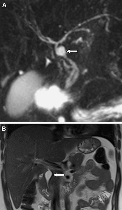 Imaging of choledochal cysts | SpringerLink
