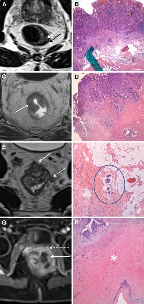 Magnetic resonance imaging of rectal cancer: staging and restaging ...