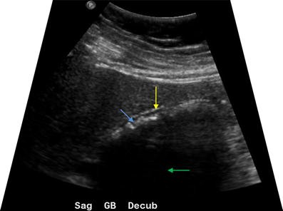 The wall-echo-shadow (WES) sign | SpringerLink