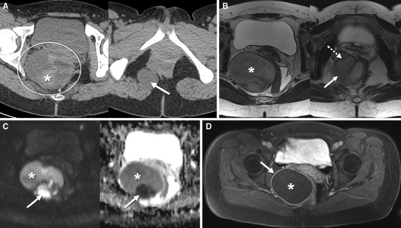 Imaging of tailgut cysts | SpringerLink