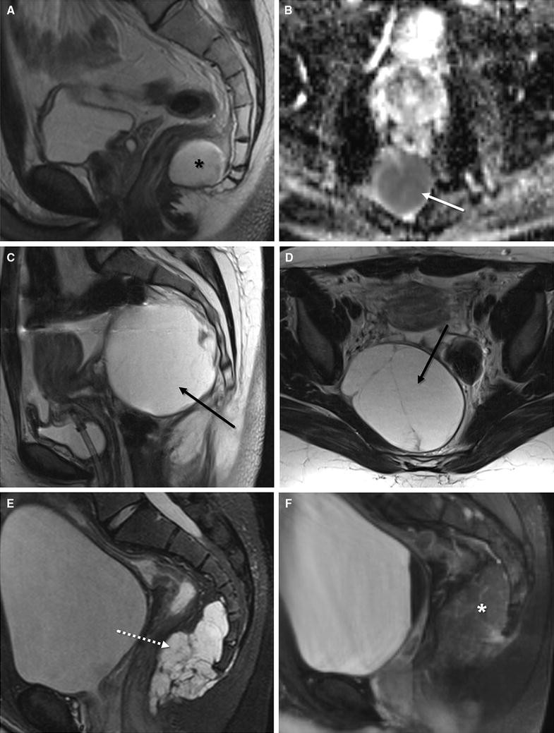 Imaging of tailgut cysts | SpringerLink