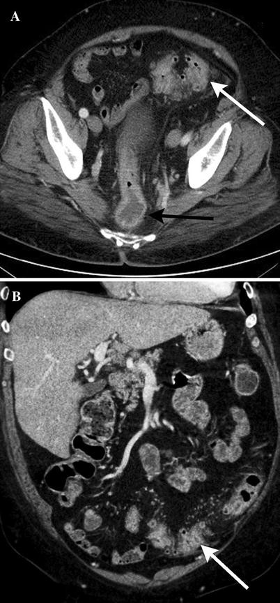 Isolated recto-sigmoid colitis: a new imaging pattern of ipilimumab ...
