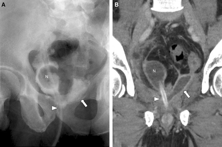 Pictorial review of orthotopic neobladder reconstruction: indication ...