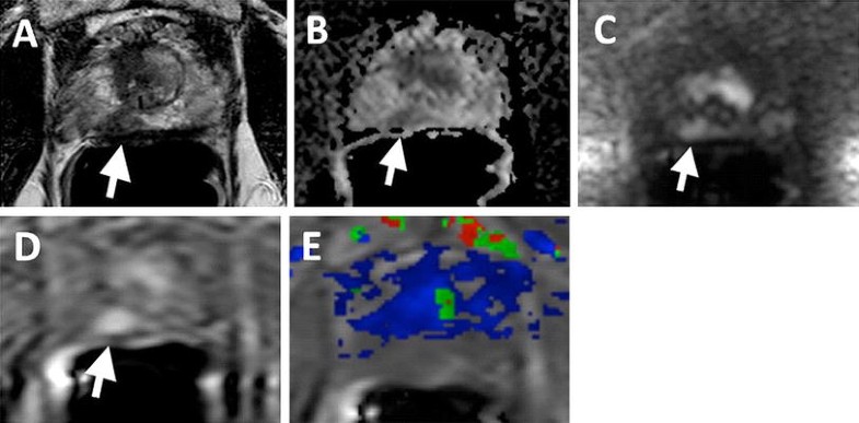 DCE MRI of prostate cancer | SpringerLink