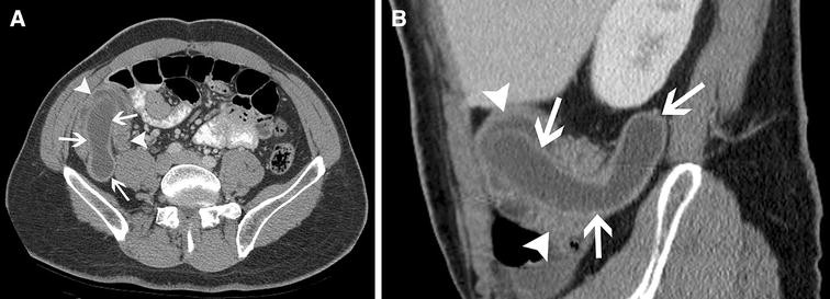 Beyond appendicitis; radiologic review of unusual and rare pathology of ...