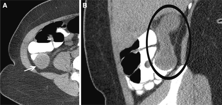 Beyond appendicitis; radiologic review of unusual and rare pathology of ...
